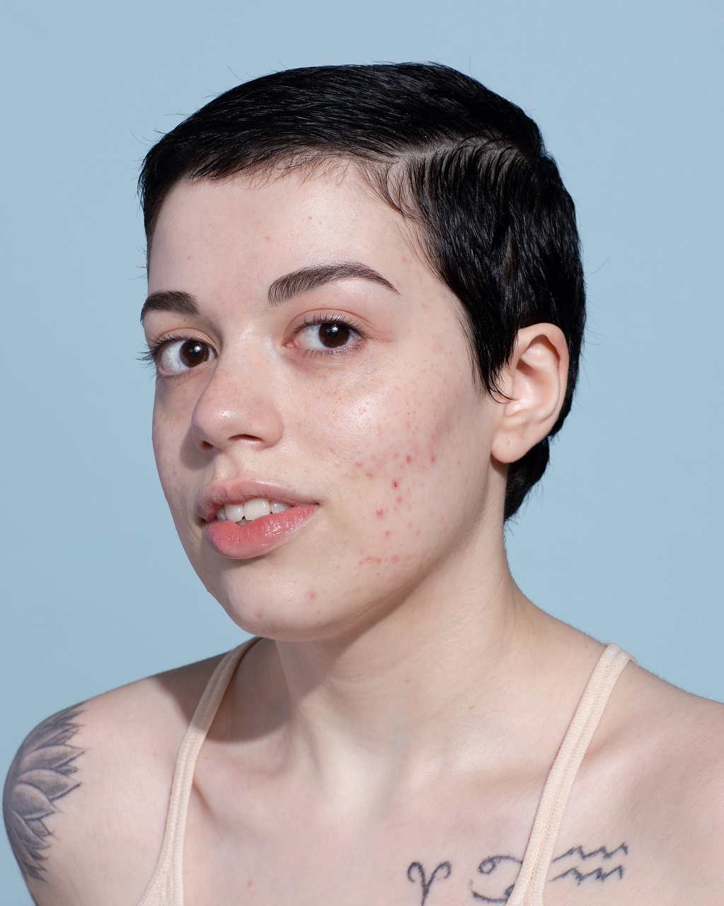 Graus de acne: quais são e quais os tratamentos para cada um?